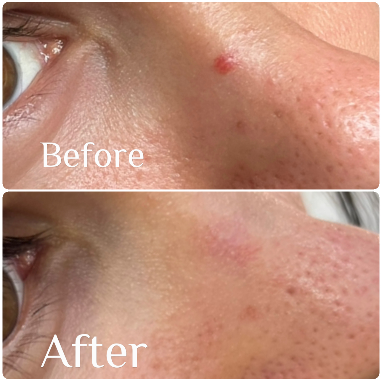 Plasmage in Long Beach: Non-Surgical Eyelid Lift - Novel U Wellness and ...