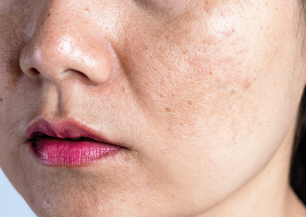 Dr. Shahnoos Mahdavi, Long Beach, laser skin resurfacing, laser ...